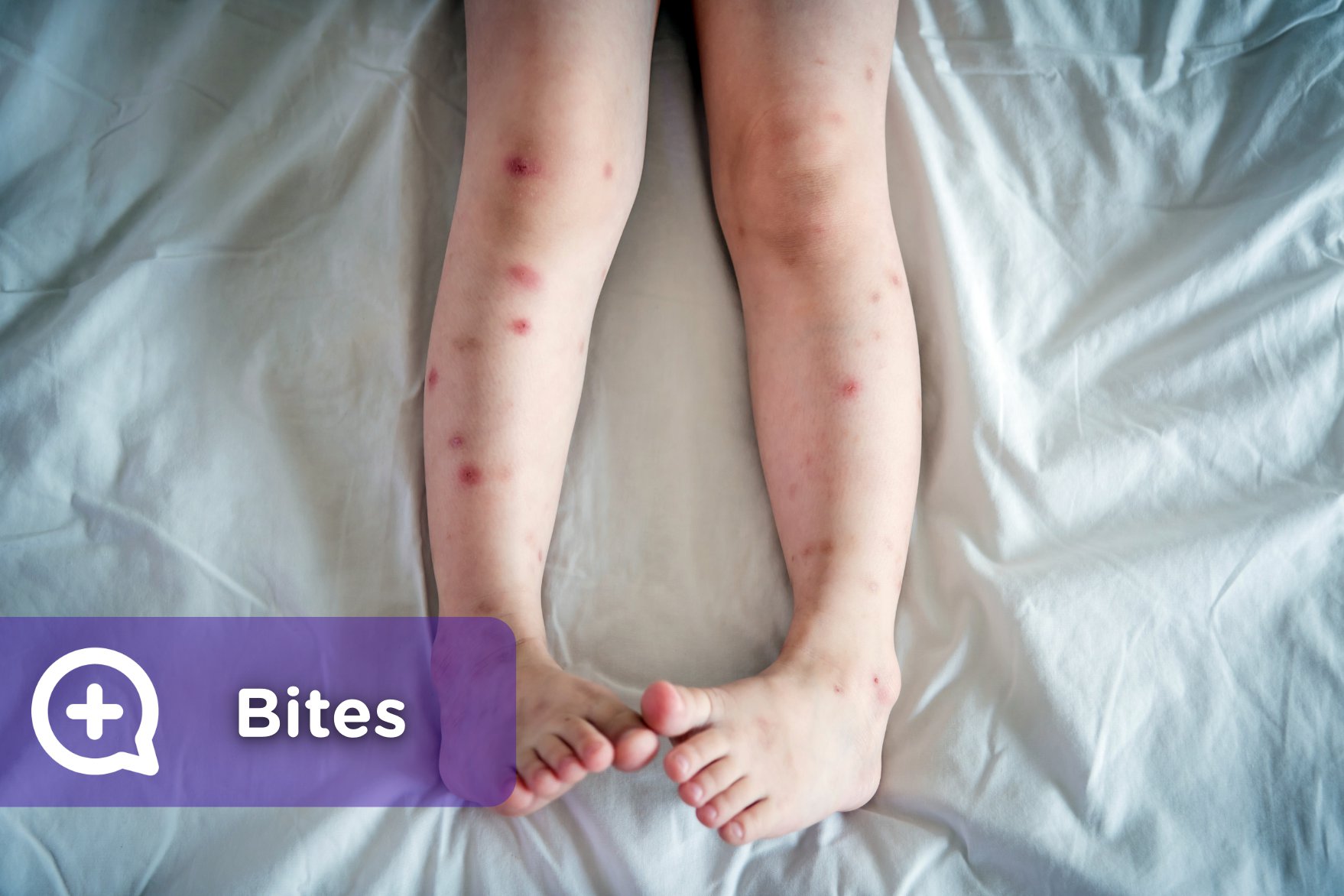 I was bitten by an insect, what do I do? - mediQuo