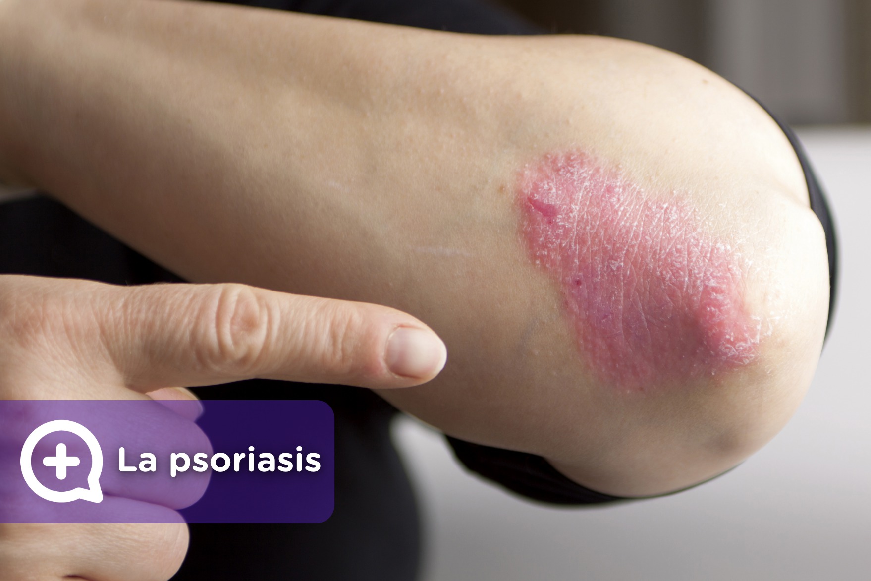 Psoriasis El Tratamiento Para Curarla Mediquo