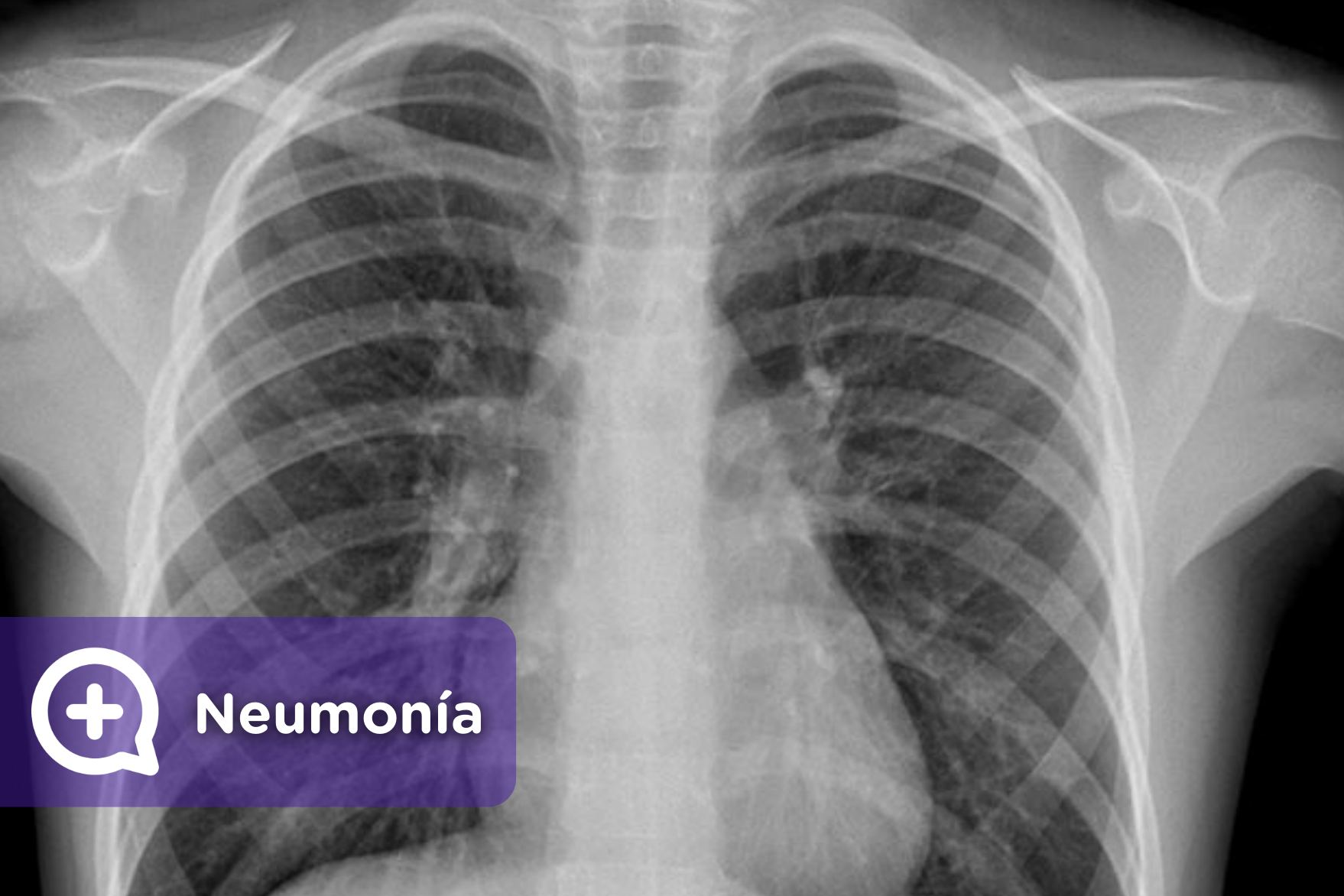 Neumonía: causas y tratamiento - mediQuo