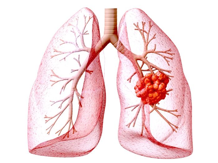 Síntomas de una embolia pulmonar - mediQuo