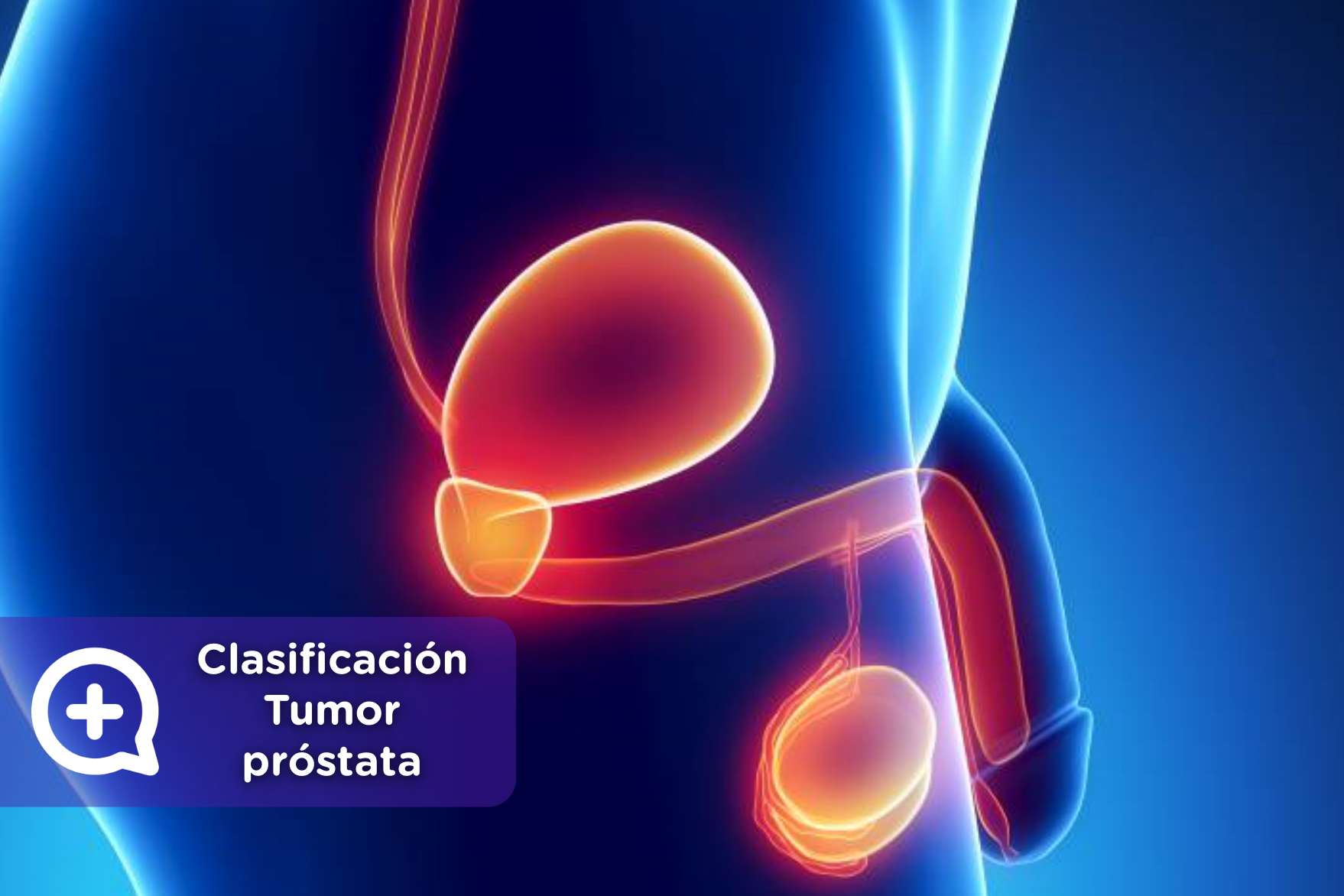 Fases Del Tumor De Próstata Mediquo
