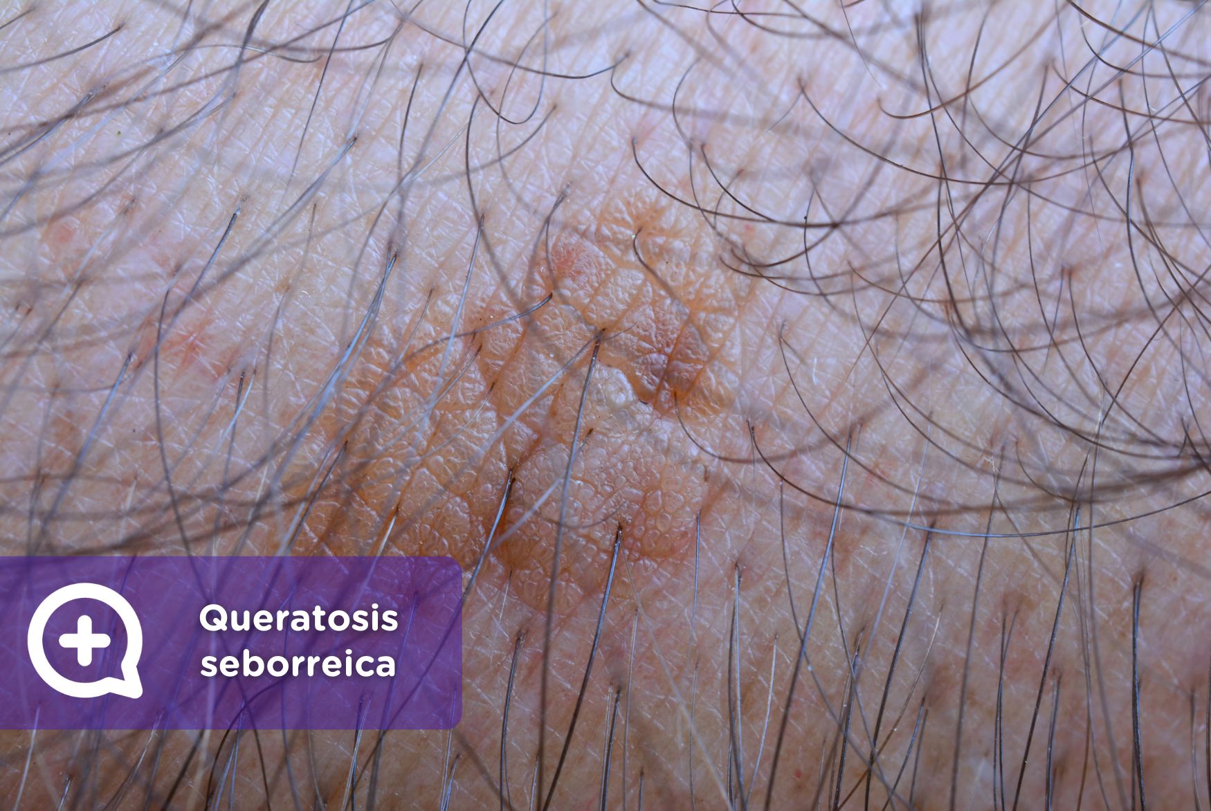Queratosis seborreica: ¿Qué es y cómo manejarla? - mediQuo